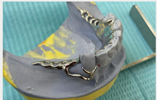 Metal Partial Denture — Cobalt-Chrome - Dental Clinic Seaford