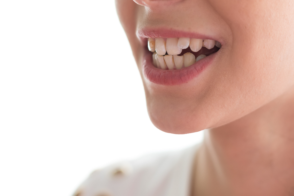 Free TMJ Consultation | Dental Clinic Seaford